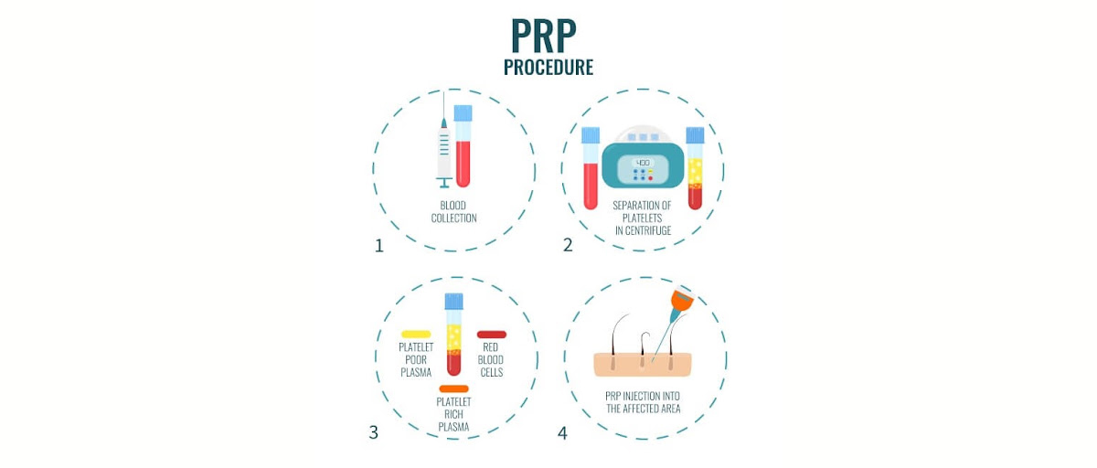 What is the difference between stem-cell therapy and PRP injection ...
